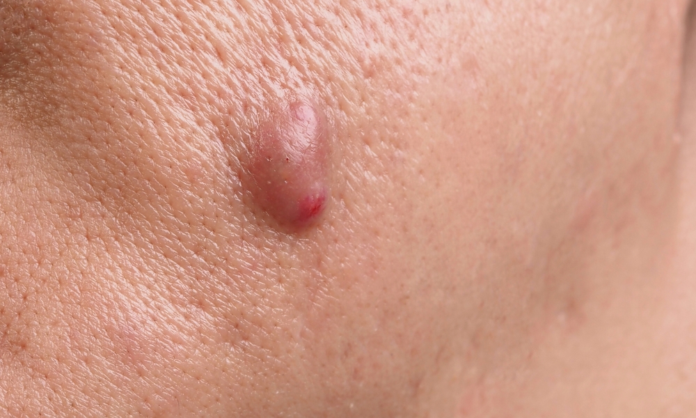 Abscess vs Cyst: What’s the Real Difference? - healthfactzone.com